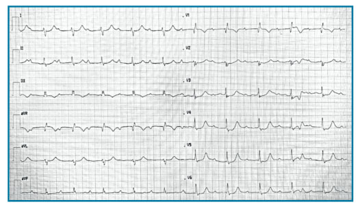 Non solo sottoslivellamento del tratto ST | Giornale Italiano di ...